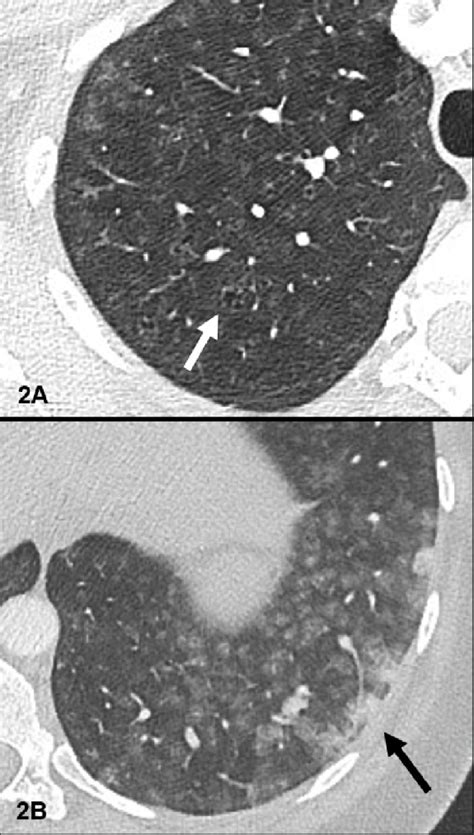 Small Centrilobular Apical Emphysema White Arrow Figure 2a And Download Scientific Diagram