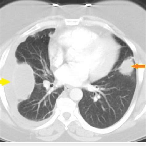 Ct Of The Chest Showing 5 X 3 X 5 Cm Lung Mass Abutting Pleura Arrow
