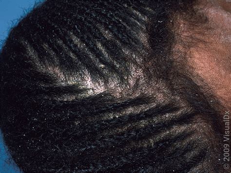 8 Dandruff Causes And How To Avoid Them With Pictures GoodRx