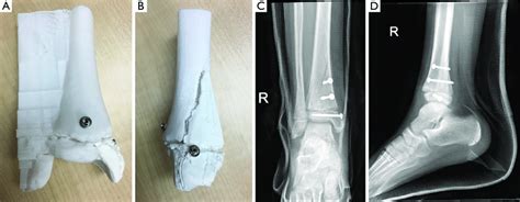 Figure Shows The Pre Surgical Simulation Of Fracture Fixation Of A