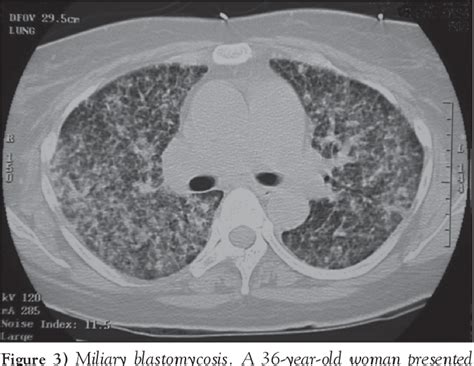 Figure 3 From Computed Tomographic Scan Evaluation Of Pulmonary Blastomycosis Semantic Scholar