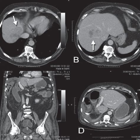 Pdf Hepatectomy For Cholangiocarcinoma In One Patient With Dubin