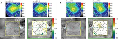 A Case Of Pathologic Myopia