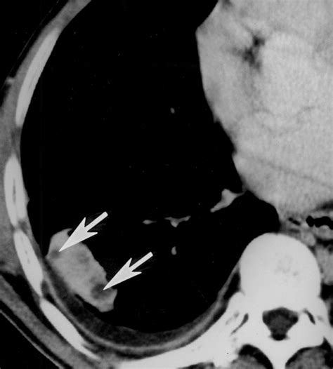 Echinococcus Multilocularis Revisited Ajr