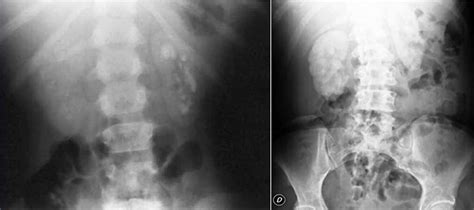 Primary Hyperoxaluria Nefrología