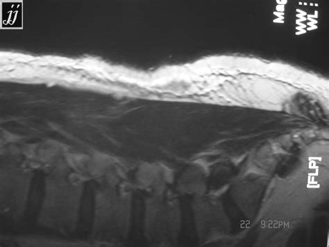 Spine Subcutaneous Cellulitis Posterior To Spinous Process 5 Radioogle