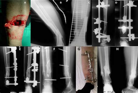 Leg Injury Treatment Tibial Fracture External Fixation Fractures