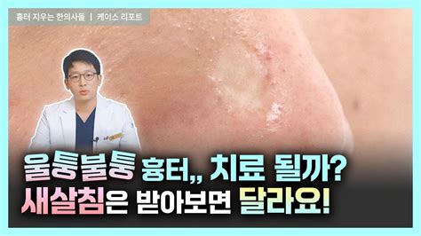 새살침 치료와 결정리를 병행하여 패인흉터에서 매끄러운 피부가 되었습니다 Youtube