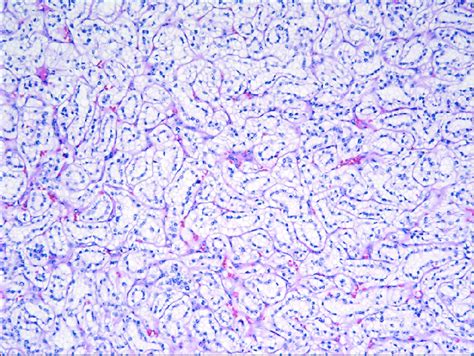 Clear Cell Papillary Renal Cell Carcinoma Bland Looking Tubules Are