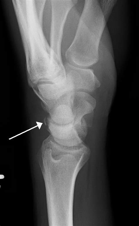 Triquetral Bone