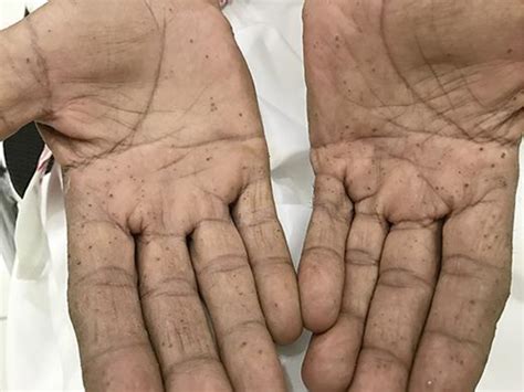 Punctate Keratosis