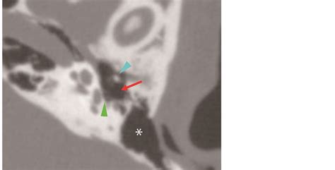 Conductive Hearing Loss With Present Acoustic Reflex A Case Report