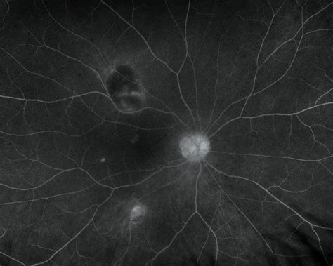 Fluorescein Angiography What It Is And What To Expect