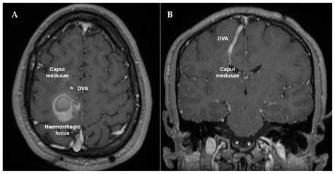 Distant Recurrence Of A Cerebral Cavernous Malformation In The Vicinity
