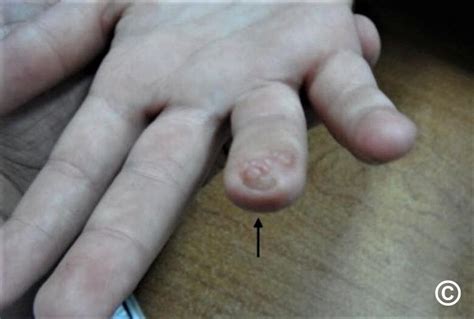Amputation Stump Neuroma