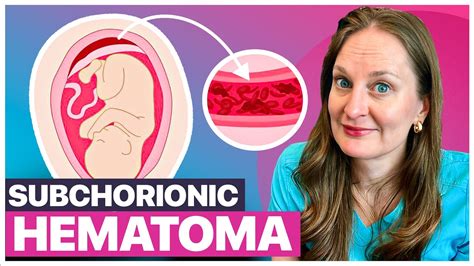 Subchorionic Hematoma And Bleeding In Pregnancy What To Expect And How To Manage It Youtube