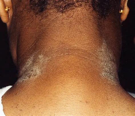 Dermatitis Eczema San Antonio Tx