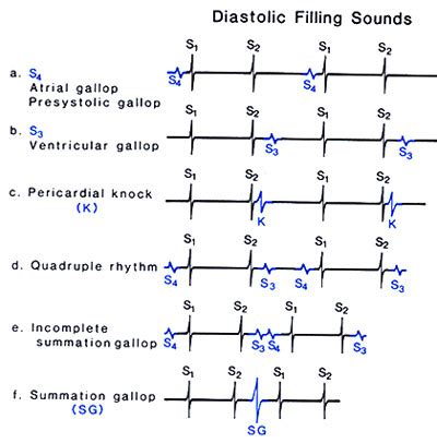 Diastolic Filling Sounds
