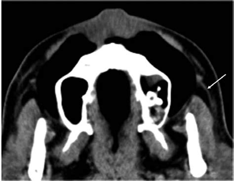 Axial Computed Tomography Scan Acquired At The Level Of Risorius And Download Scientific