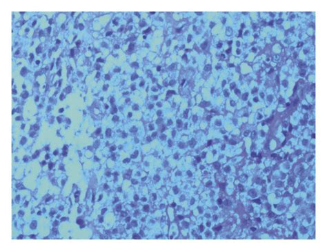 Biopsies Showing Infiltration By Histiocytic Cells A Cervical Lymph