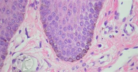 Labial Melanotic Macule Pathology Image