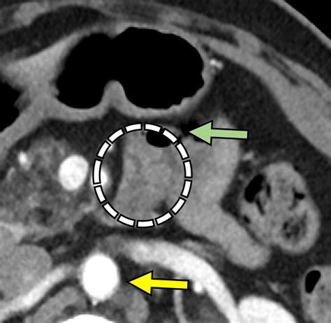 Imaging Spectrum Of Duodenal Emergenciesradiographics