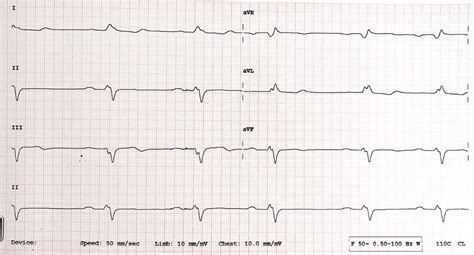 Pseudo Bradycardia