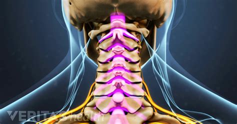 Cervical Foraminal Stenosis Artofit