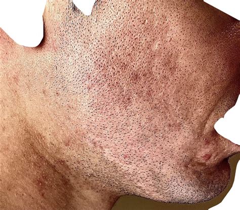 Dangers Of Co2 Laser