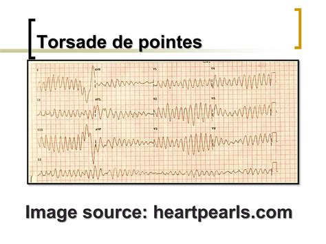 Broad Complex Tachycardia Ppt