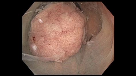 Colonoscopy Sigmoid Colon Polyps Youtube