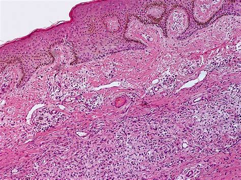 Dermatofibroma Libre Pathology