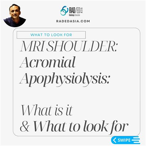 Acromial Apophysiolysis Or Apophysitis Mri Findings Radiology Education Asia