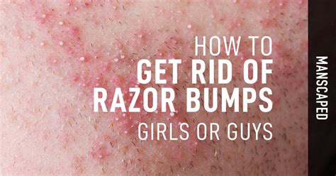 How To Get Rid Of Razor Bumps Girls Or Guys MANSCAPED Blog