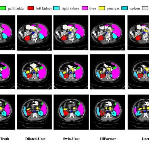 Comparative Segmentation Results On The Synapse Dataset Download Scientific Diagram