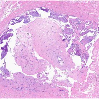 Spermatic Cord Artery Demonstrating Intimal Fibrosis And Calcification Download Scientific