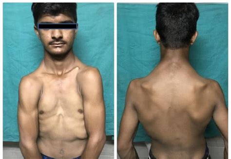Facial View Showing A Brachycephalic Head And Hypermobility Of The