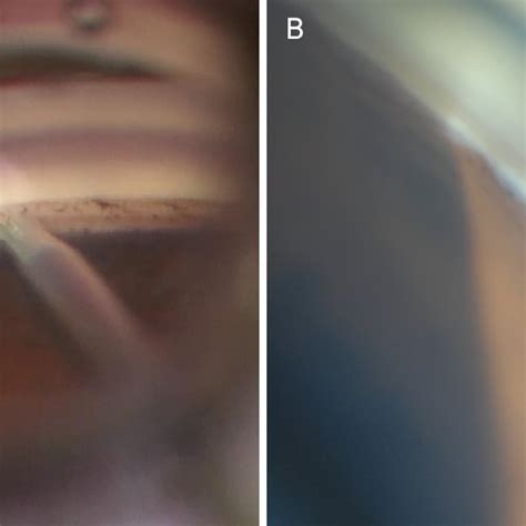 Trabecular Micro Bypass Stent Istent A Implantation Of Istent