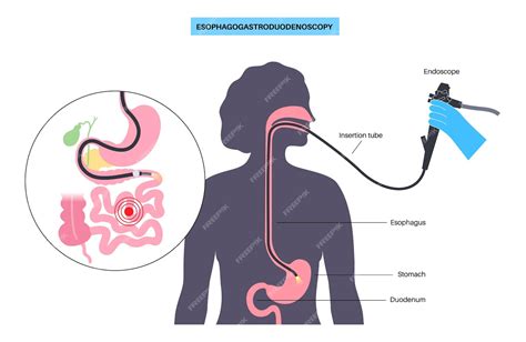 Premium Vector Esophagogastroduodenoscopy Medical Poster Diagnostic