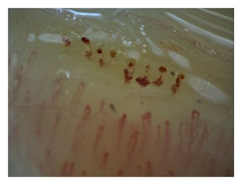 The Second Type Of Videocapillaroscopic Images Abnormal Enlargement