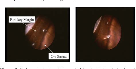 Figure 2 From Retinal Prostheses And Artificial Vision Semantic Scholar