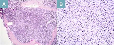 A Bone Marrow Follicular Lymphoma Diffuse Pattern Of Growth He