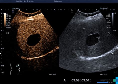Complex Liver Cyst Series Of Images Atlas Of Ultrasound