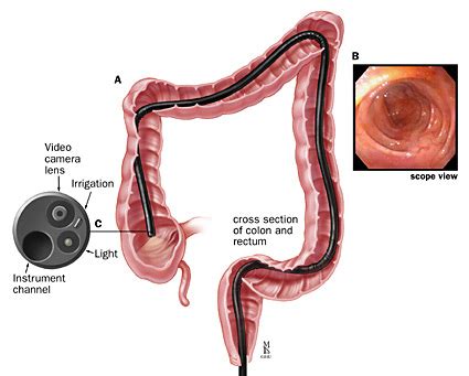 Instrument Used In Colonoscopy Health Checklist