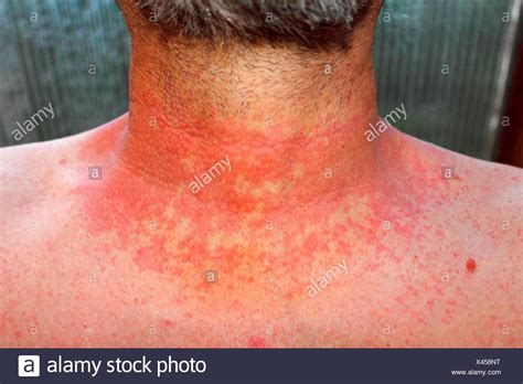Red Blotchy Rash On Neck