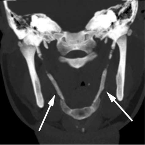The Case Of Stylohyoid Calcification With Clarification Sleep And Tmj