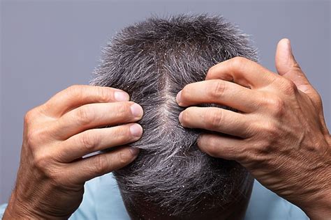 Can Scalp Eczema Cause Hair Loss And How Do You Treat It