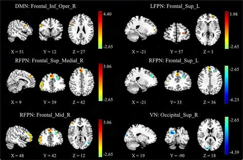 Group Functional Connectivity Fc Differences Within Resting State