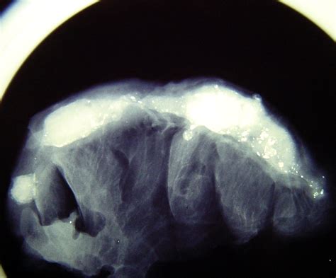 Appendix Surgery Photos