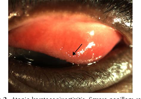Atopic Conjunctivitis